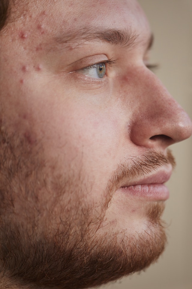 Understanding Acne In Men: Causes & Treatment Options | AndSons SG