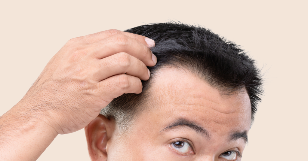 Hair Loss In Men: 10 Important Facts You Should Know | AndSons SG
